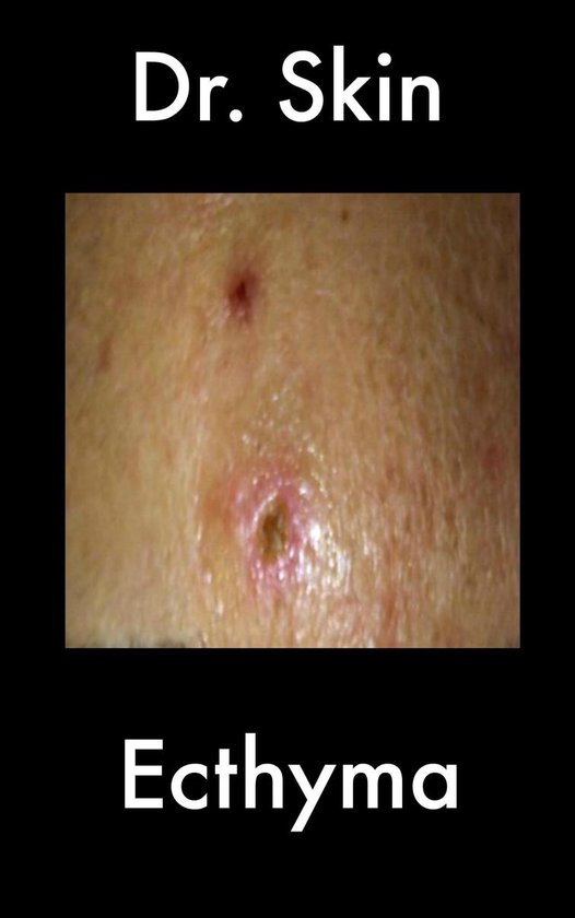 Ecthyma (ebook), Dr Skin | 9781310410482 | Boeken | bol.com