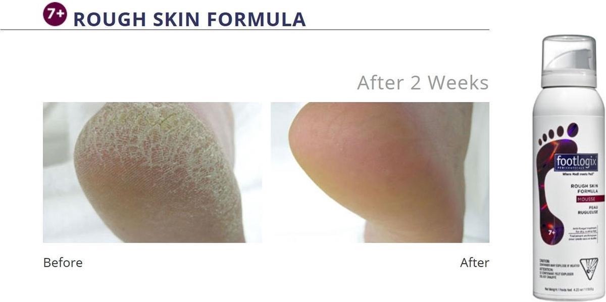 Footlogix Rough Skin Formula Voet Mousse | bol
