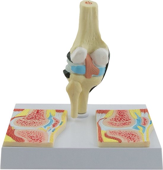 Het menselijk lichaam - anatomie model knie met reuma | bol