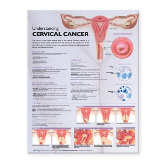 Understanding Cervical Cancer Anatomical Chart, Anatomical Chart ...