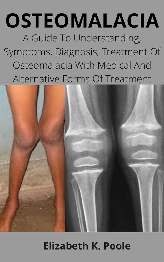 OSTEOMALACIA (ebook), Elizabeth K. Poole | 1230006267476 | Boeken | bol.com