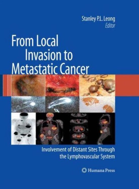 From Local Invasion to Metastatic Cancer | 9781627039437 | Leong ...