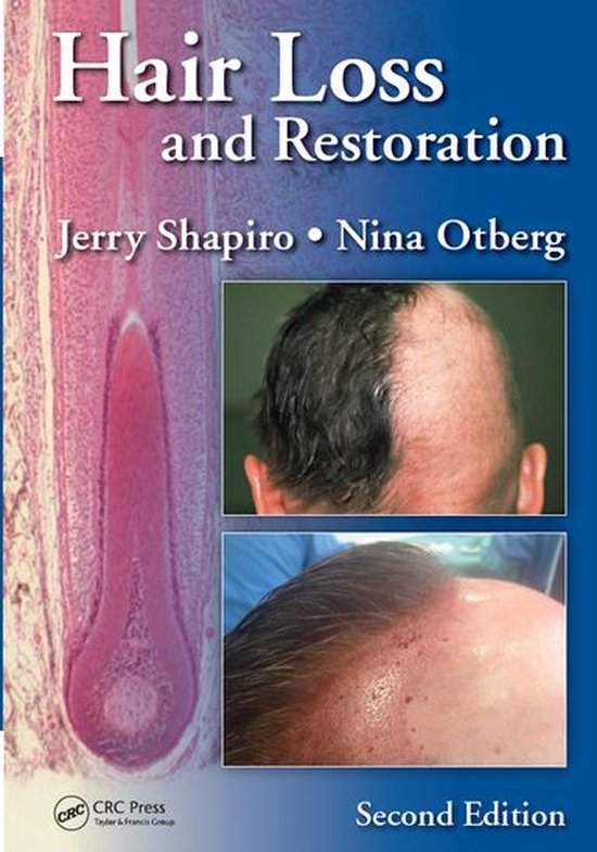 Hair Loss and Restoration (ebook), Jerry Shapiro | 9780429586293 ...