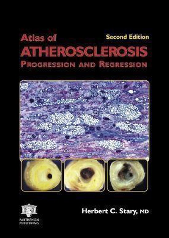 Atlas of Atherosclerosis Progression and Regression (ebook), Herbert C ...