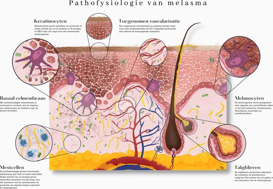 The social skincoach - Melasma - Huidkaart - Anatomie poster huid - A4 ...