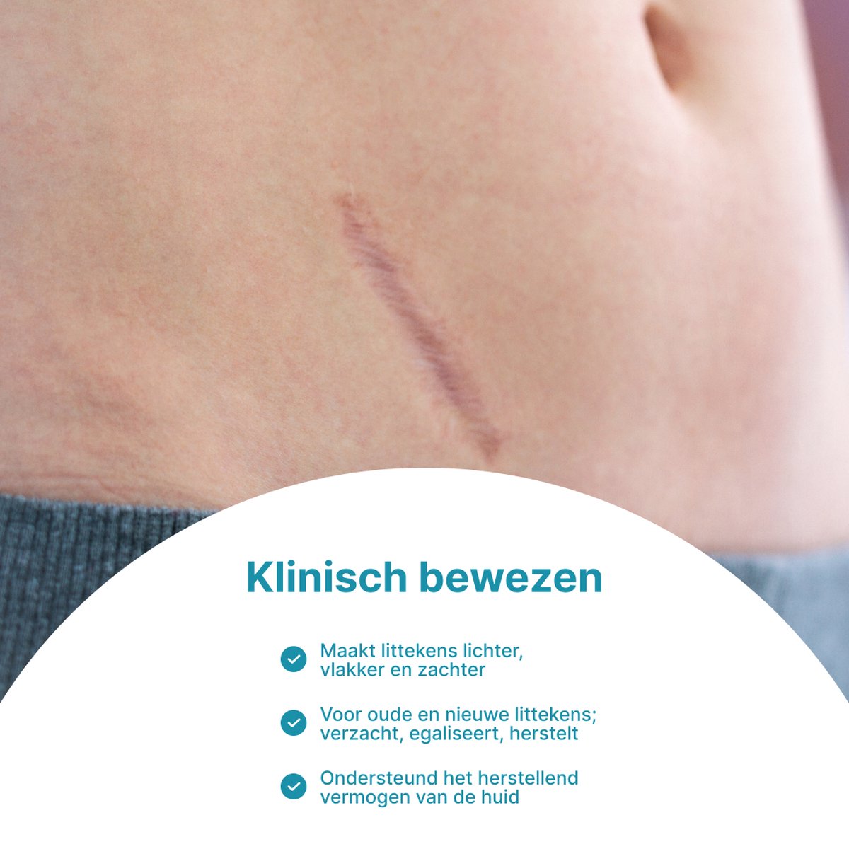 Littekenvervager- Vermindert Zichtbaarheid van Littekens- Siliconen ...