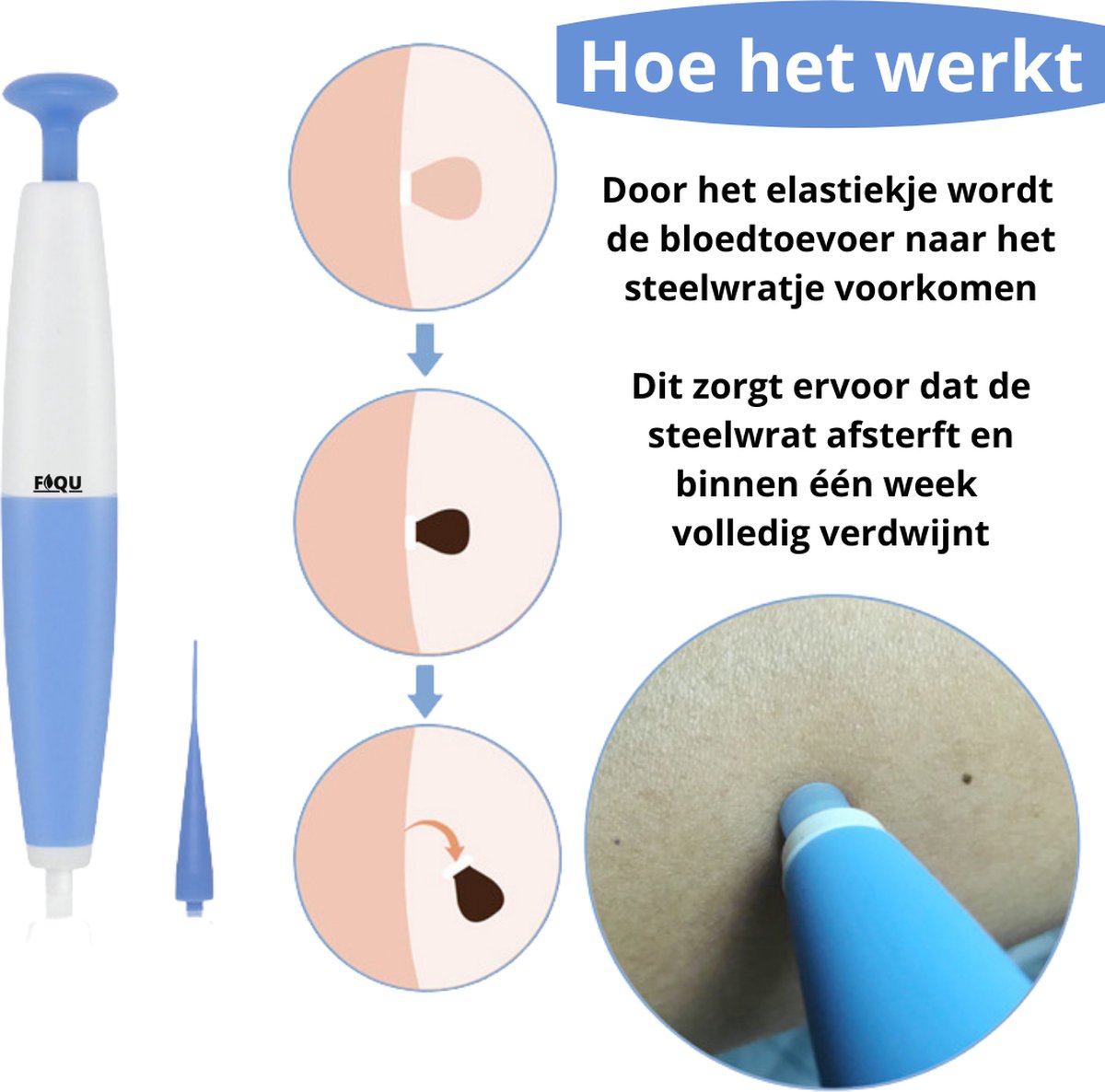 Foqu Steelwratjes Verwijderen - Skin Tags - Steelwratten Verwijderaar ...