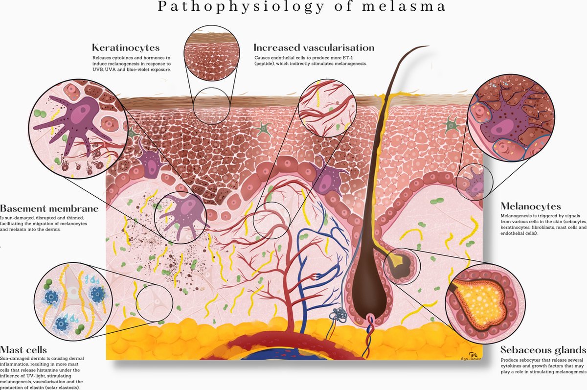 The social skincoach - Melasma - Huidkaart - Anatomie poster huid - A4 ...
