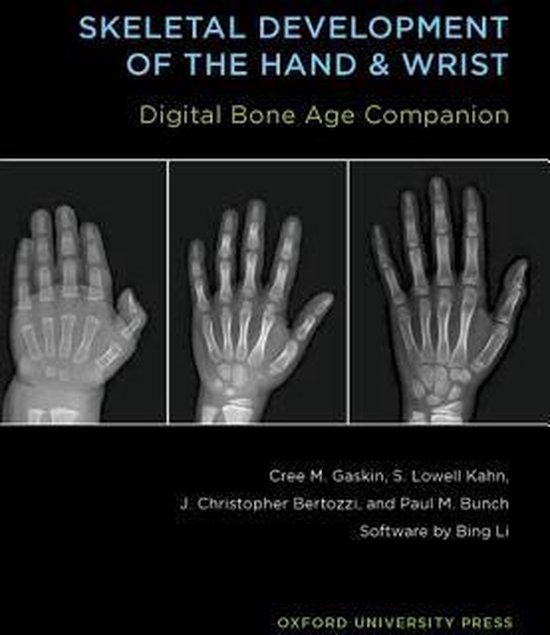 Skeletal Development of the Hand and Wrist Digital Bone Age Companion ...
