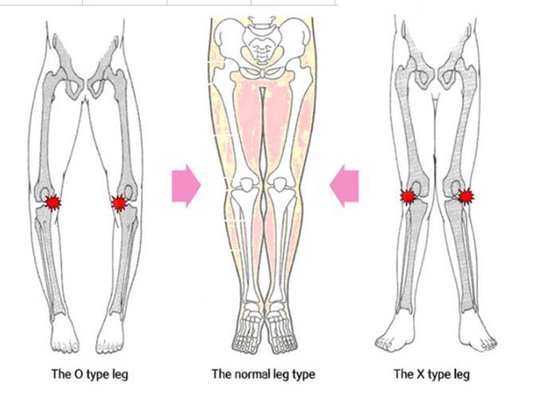 bol.com | WiseGoods - Premium Houding Corrector - O/X benen - X Been ...