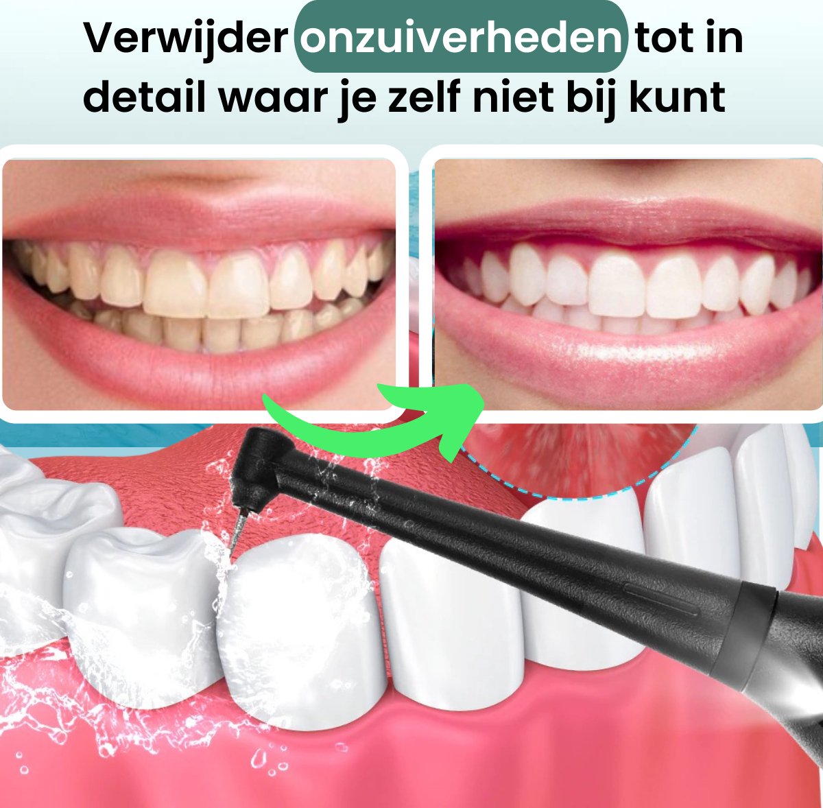 Complete Set Elektrische Tandsteen verwijderaar - Tandplak Verwijderaar ...