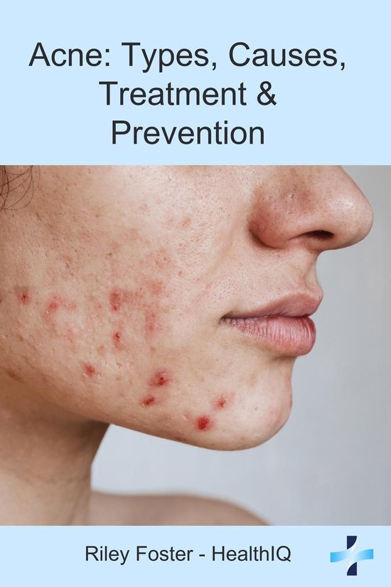 Acne: Types, Causes, Treatment & Prevention (ebook), Riley Foster | 9798230383376 | Boeken | bol