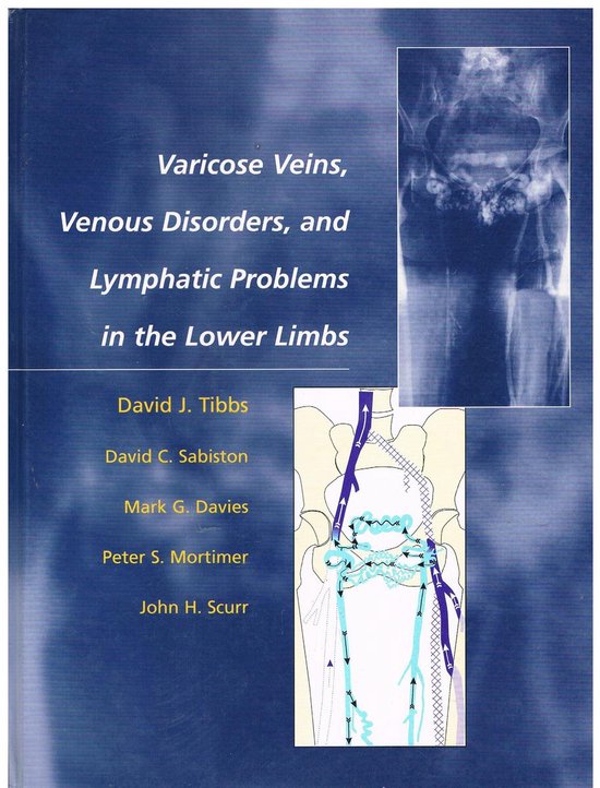 Varicose Veins,Venous Dis C, Tibbs | 9780192627629 | Boeken | bol.com