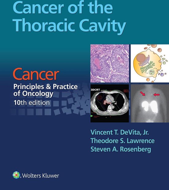 Cancer of the Thoracic Cavity (ebook), Vincent Devita | 9781496338242 ...