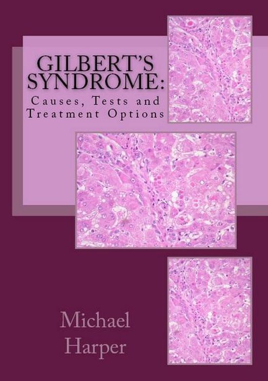 Gilbert's Syndrome: Causes, Tests and Treatment Options (ebook ...