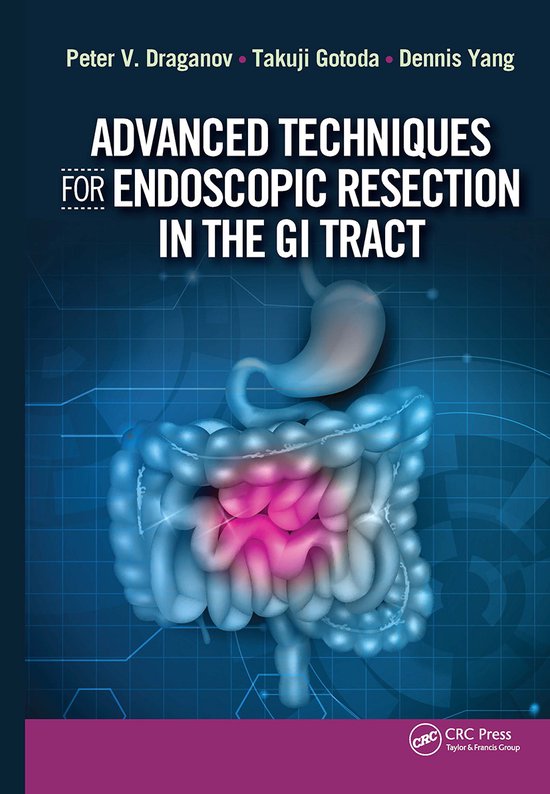 Advanced Techniques for Endoscopic Resection in the GI Tract ...
