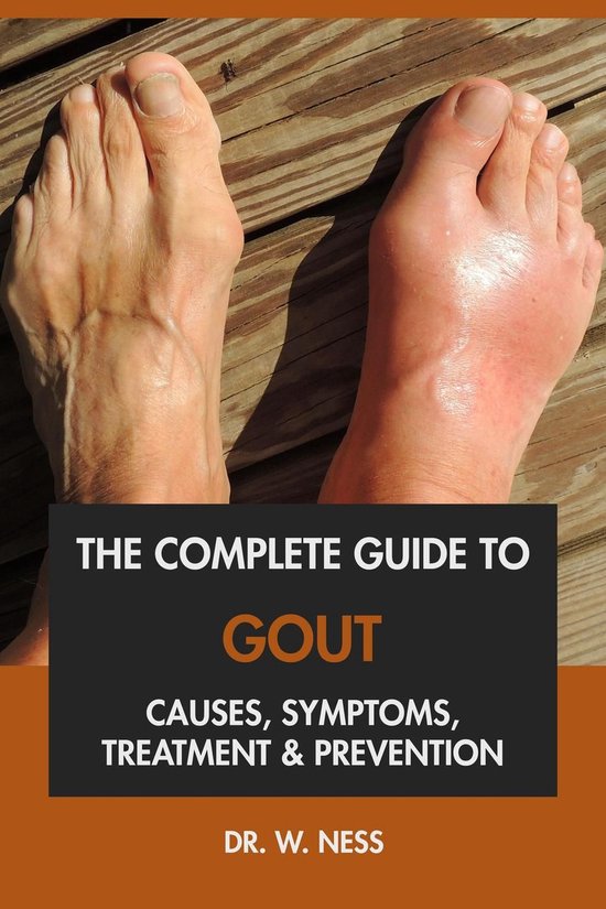 The Complete Guide to Gout: Causes, Symptoms, Treatment & Prevention (ebook), Dr. W.... | bol