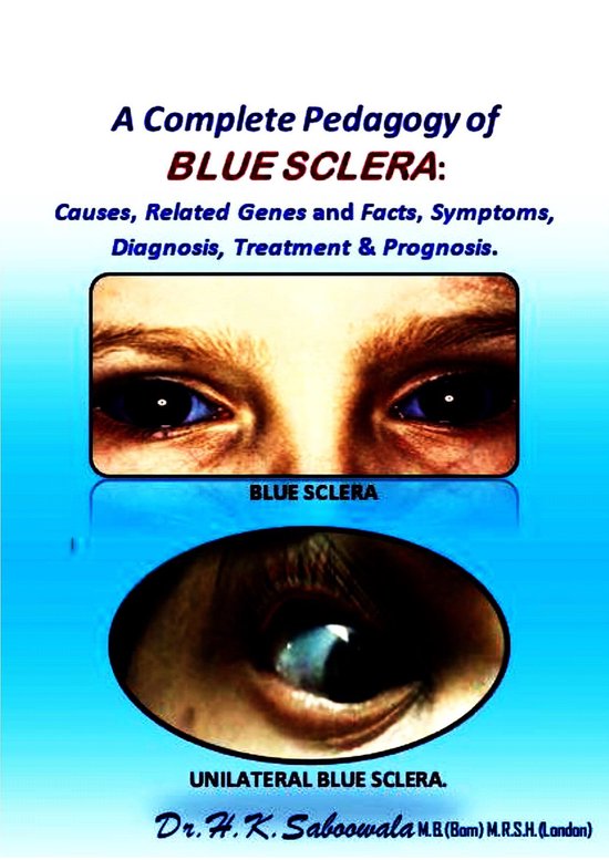 A Complete Pedagogy of BLUE SCLERA: Causes, Related Genes and Facts ...