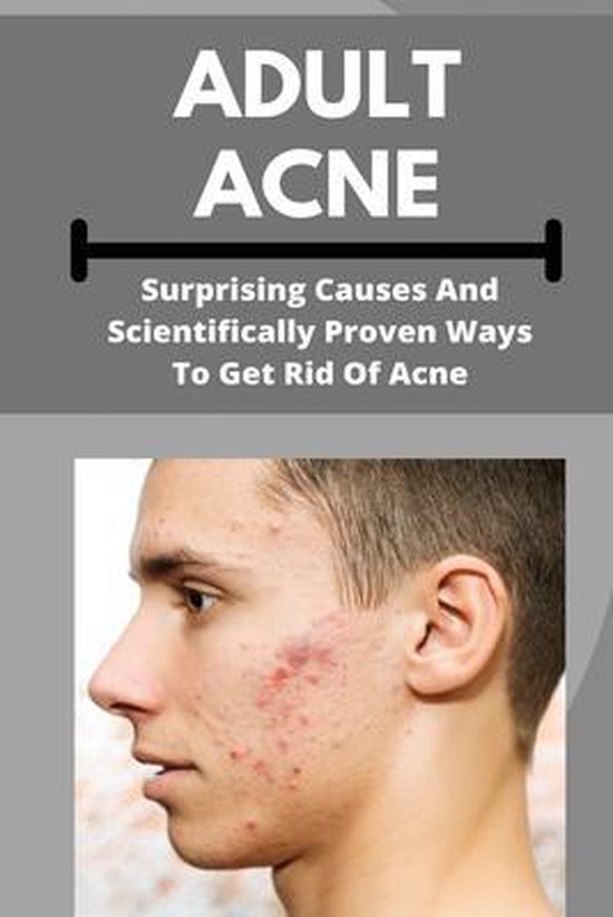 Adult Acne Surprising Causes And Scientifically Proven Ways To Get Rid