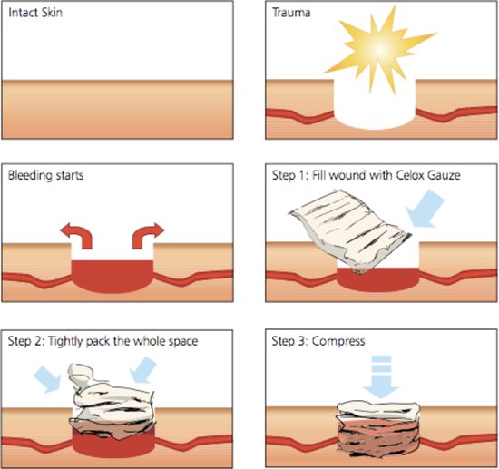 Celox Bloedstelpend Gaas - Hemostatisch verband voor levensbedreigende ...