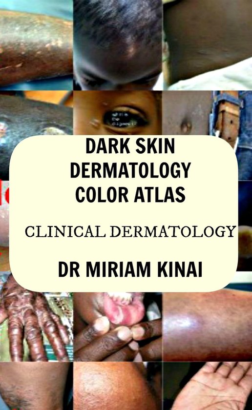 Dark Skin Dermatology Color Atlas (ebook), Miriam Kinai | 9781476460499 | Boeken | bol