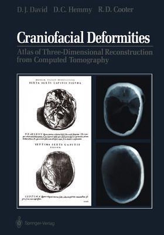 Craniofacial Deformities | 9781461279266 | David J. David | Boeken ...