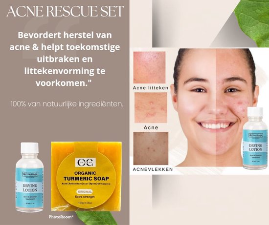 Acne Rescue Set – Tegen Puistjes, Littekens & Terugkerende Acne | Voor ...