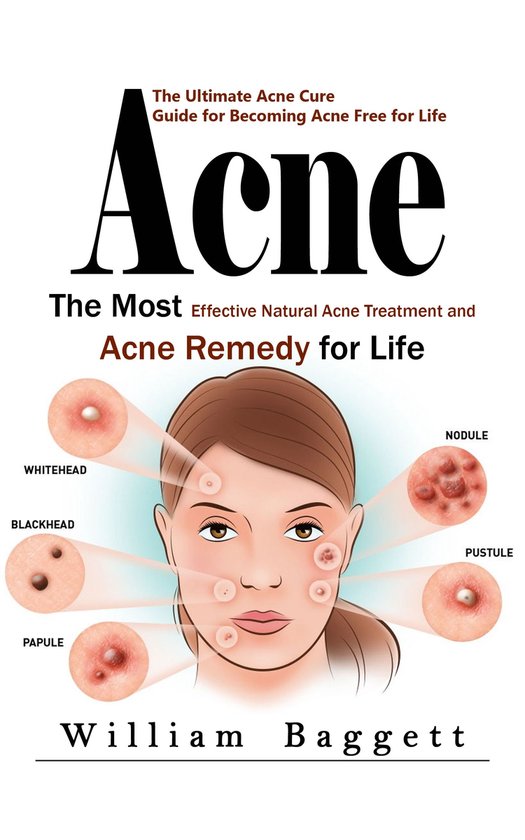 Acne: The Ultimate Acne Cure Guide for Becoming Acne Free for Life (The ...