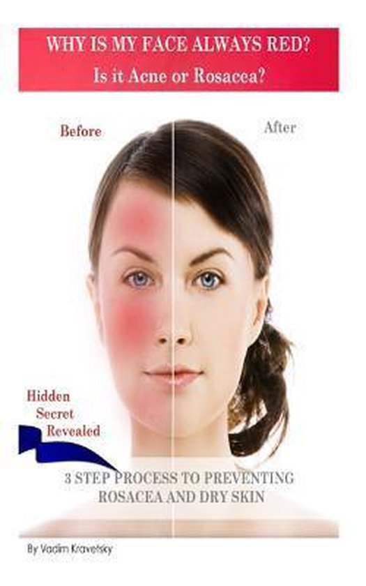 Why Is My Face Always Red? Is It Acne or Rosacea?, Vadim Kravetsky ...