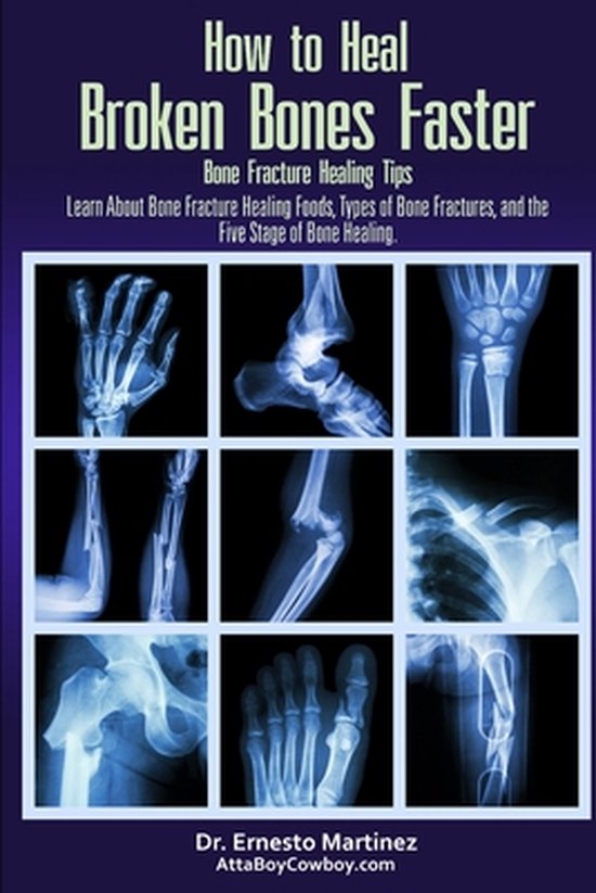 How to Heal Broken Bones Faster. Bone Fracture Healing Tips, Dr Ernesto ...