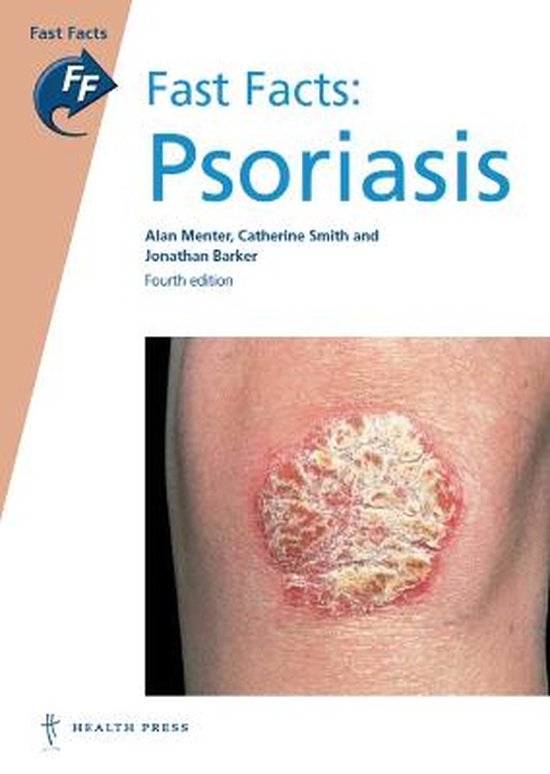 Fast Facts: Psoriasis | 9781908541741 | Alan Menter, Md | Boeken | bol.com