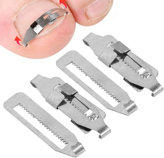 Ingegroeide Teennagel Corrector 2 Stuks - Paronychia Correctie - Rvs ...