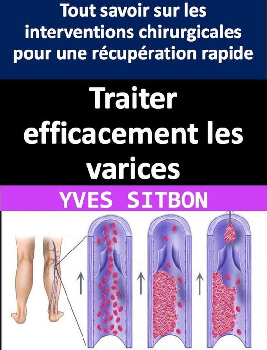 Traiter efficacement les varices : Tout savoir sur les interventions chirurgicales... | bol.com