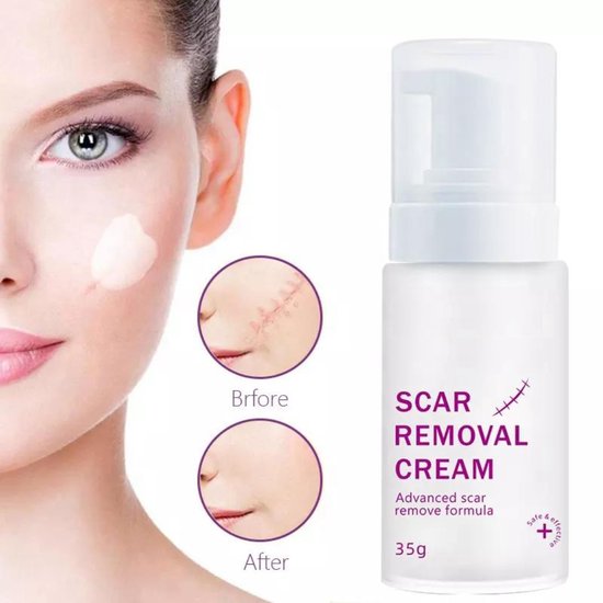 Littekencreme - Litteken verwijderaar - makkelijk Littekens verwijderen ...