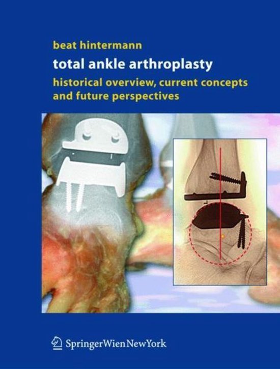 Total Ankle Arthroplasty | 9783211212523 | Beat Hintermann | Boeken | bol