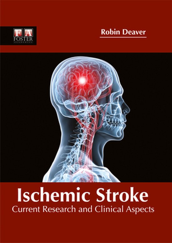 Ischemic Stroke: Current Research and Clinical Aspects | 9781632424952 | Boeken | bol