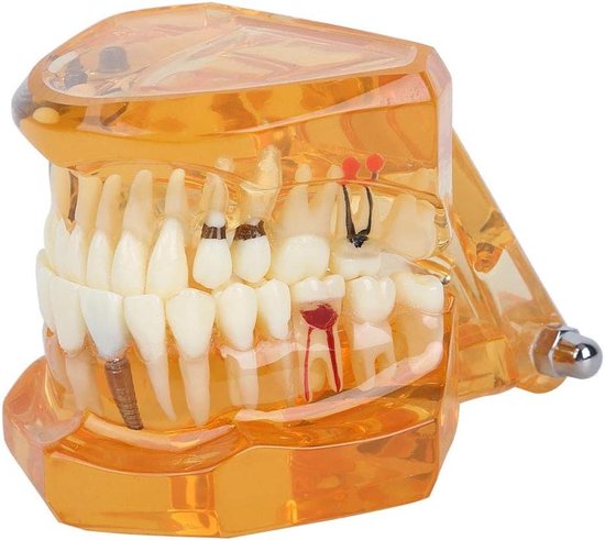Tanden Studie Model Inferieure Precisie Implantaat Demo Tandkaak ...