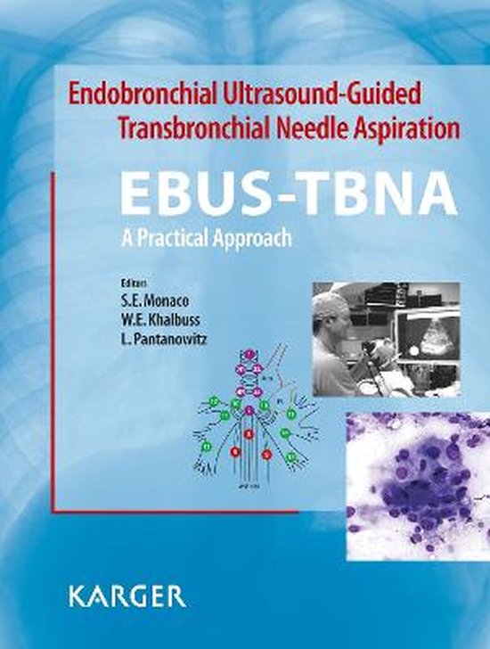 Endobronchial Ultrasound Guided Transbronchial Needle Aspiration Ebus