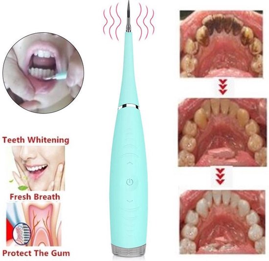 D'Evreuxé - Elektrisch Tandplak Verwijderen - Flosapparaat - Slechte ...