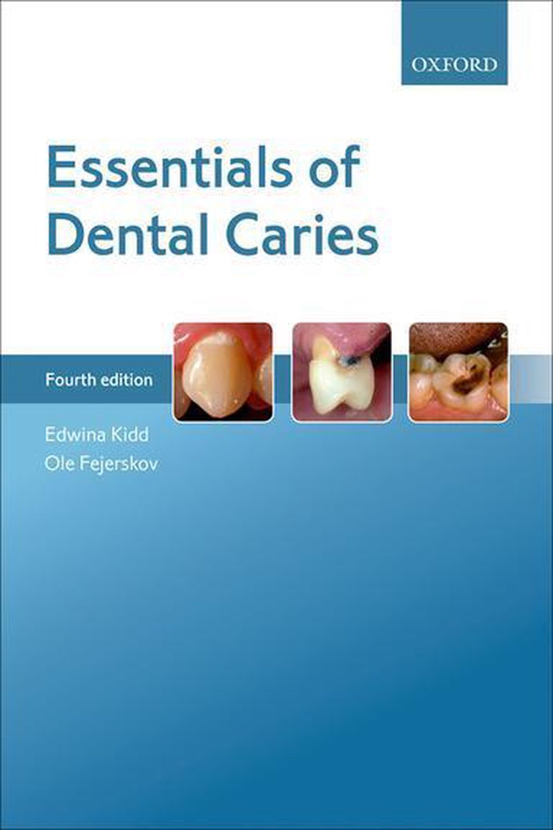 Essentials of Dental Caries (ebook), Edwina Kidd | 9780191058189 ...