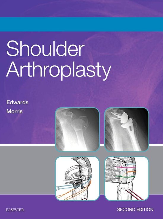 Shoulder Arthroplasty E-Book (ebook), t. Bradley Edwards, Md ...