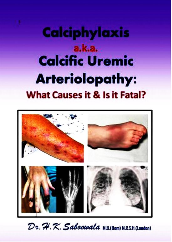 Calciphylaxis a.k.a. Calcific Uremic Arteriolopathy: What Causes it ...