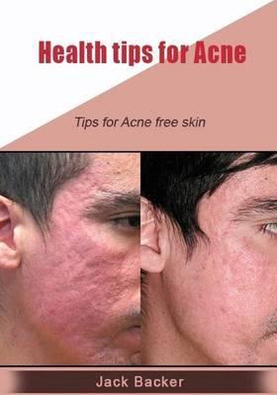 Health Tips for Acne | 9781505647594 | Jack Backer | Boeken | bol.com