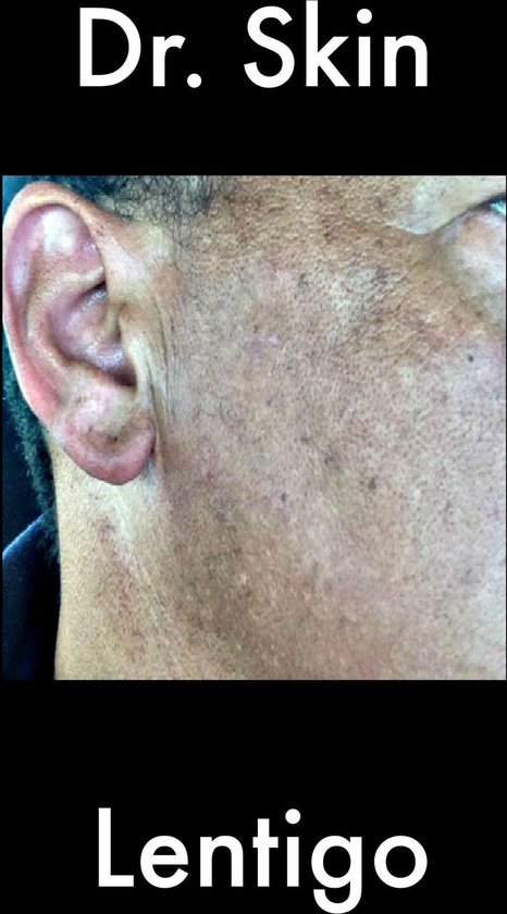 Lentigo (ebook), Dr Skin | 9781310326042 | Boeken | bol