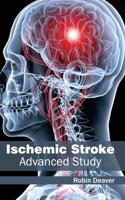 Ischemic Stroke: Advanced Study | 9781632412706 | Boeken | bol