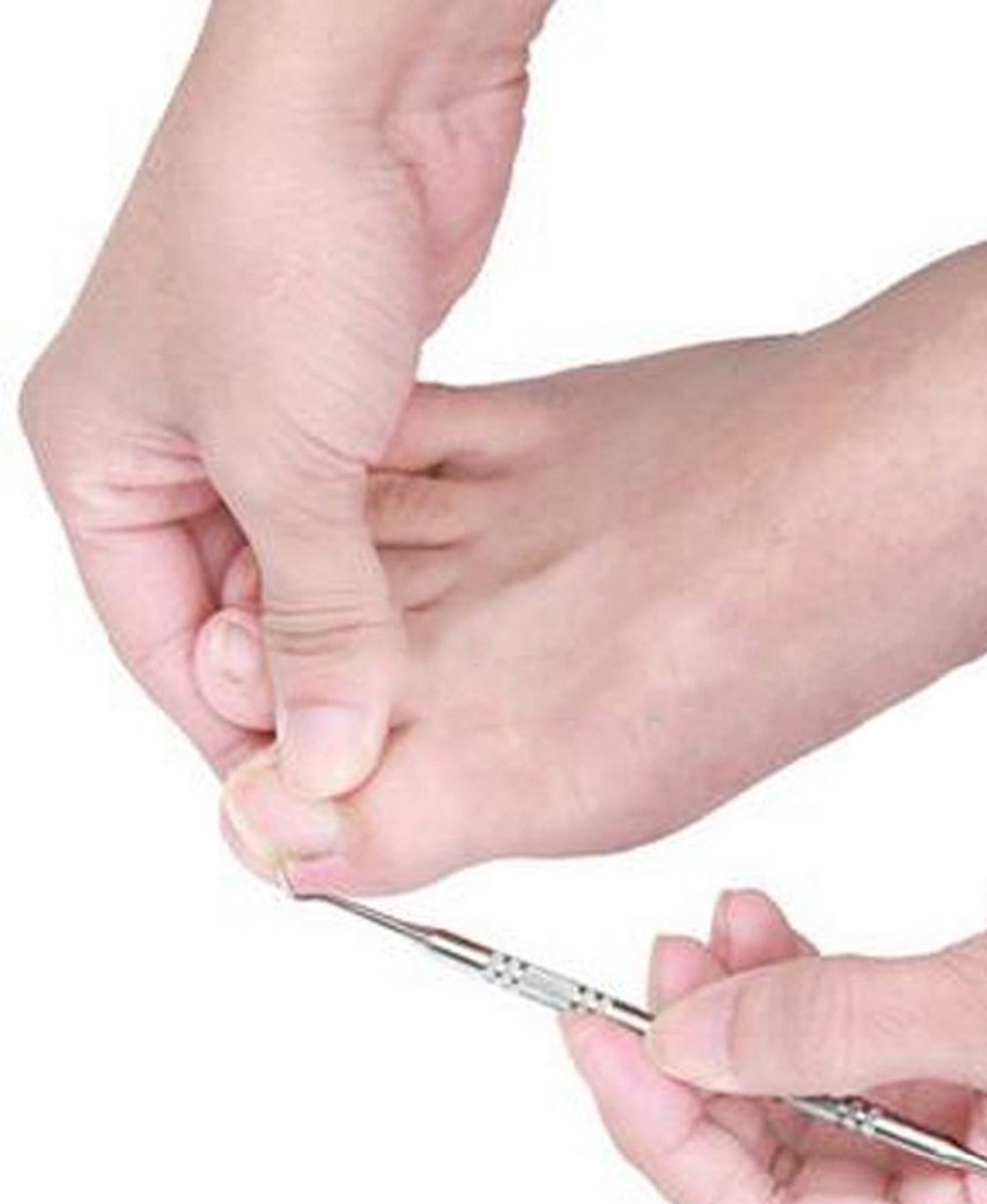 Teen Nagellifter I Nagellifter I Ingegroeide Teennagel Corrector I ...