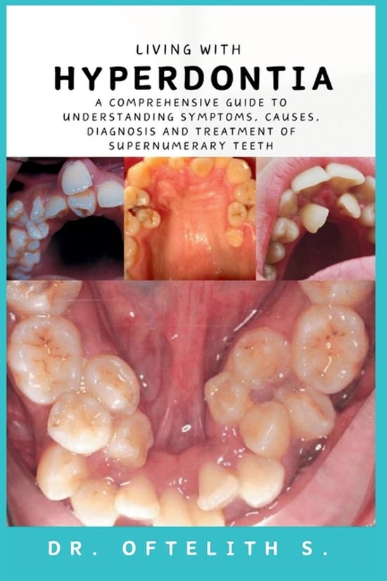 Living with Hyperdontia, Oftelith S | 9798323384006 | Boeken | bol