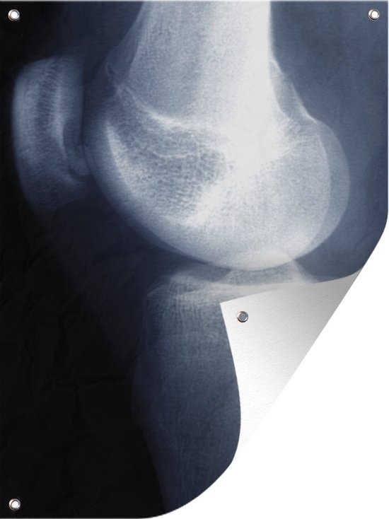 Une rotule dont le cartilage est séparé de la rotule affiche de jardin ...