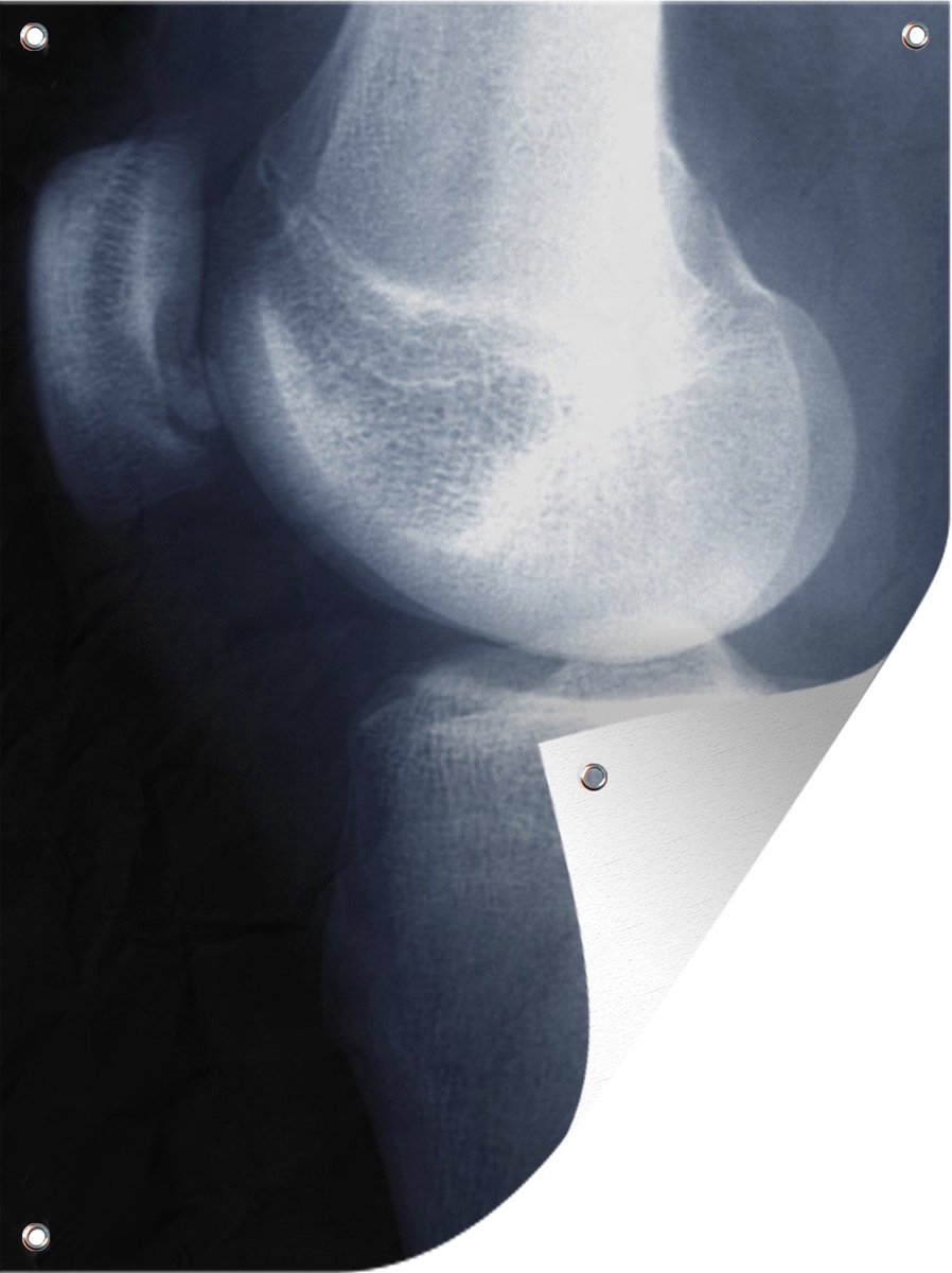 Une rotule dont le cartilage est séparé de la rotule affiche de jardin ...