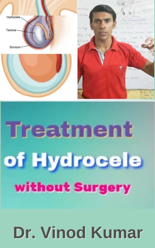 Treatment of Hydrocele without Surgery (ebook), Dr. Vinod Kumar ...